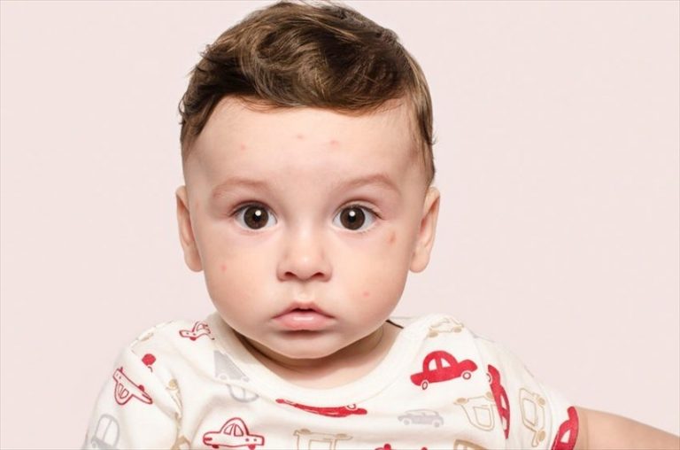 Mengenal Rubella (Campak Jerman) - Blog K24Klik.com